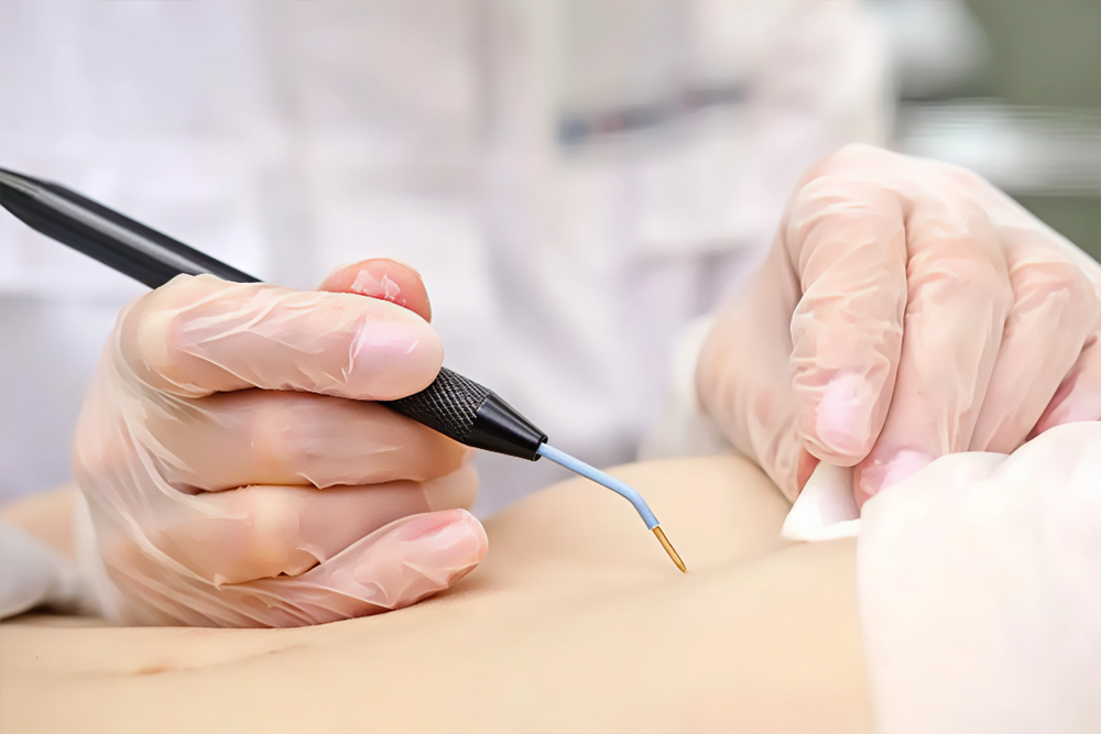Cauterización de Condilomas - nubicaginecologia.com